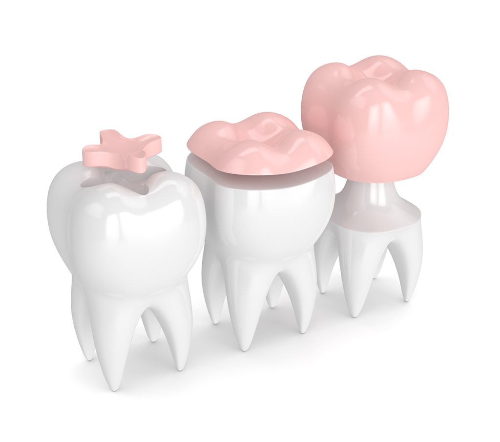 Inlays-Onlays Edinburg TX | Fillings | Cavity | Porcelain