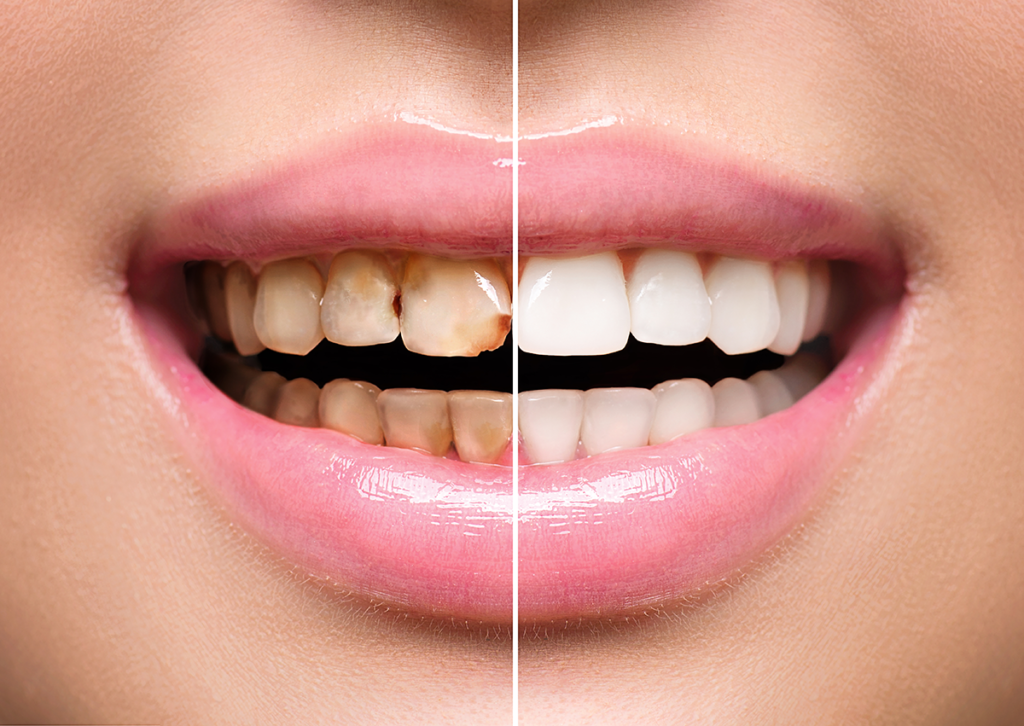 Smile Makeover Edinburg | Veneers | Whitening | Implants